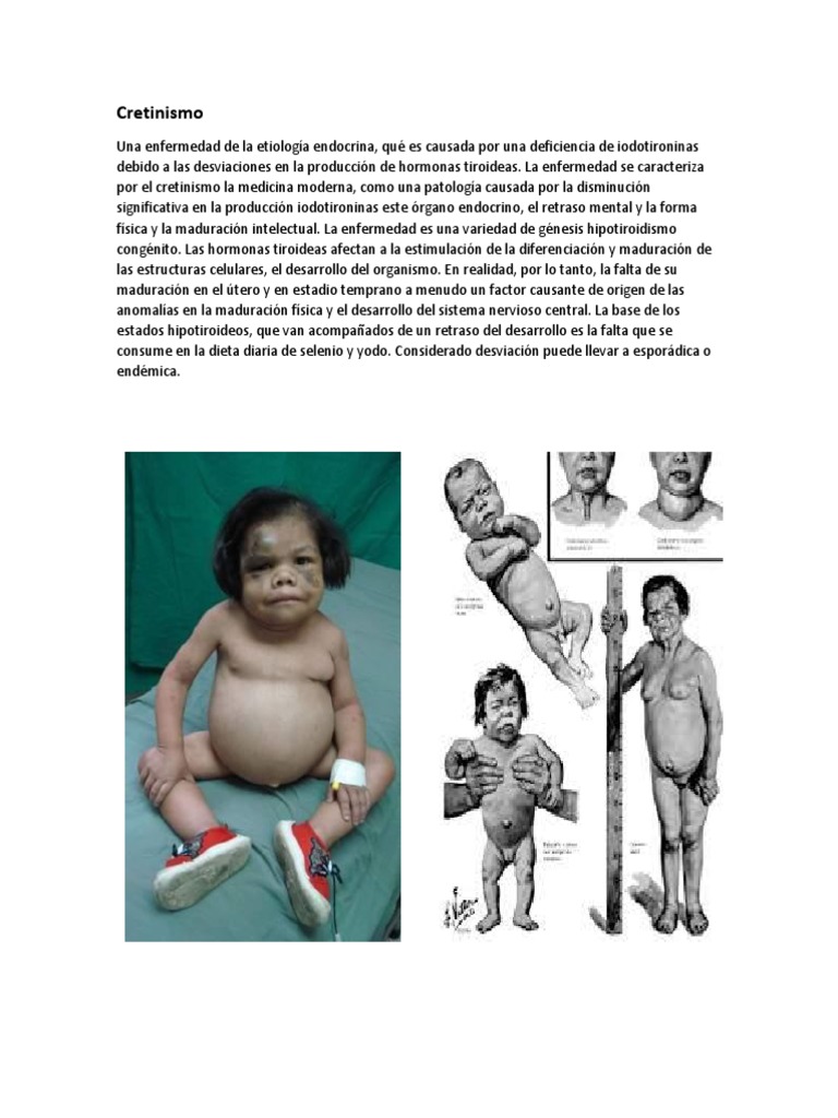 Cretinism o | PDF | Hipotiroidismo | Tiroides
