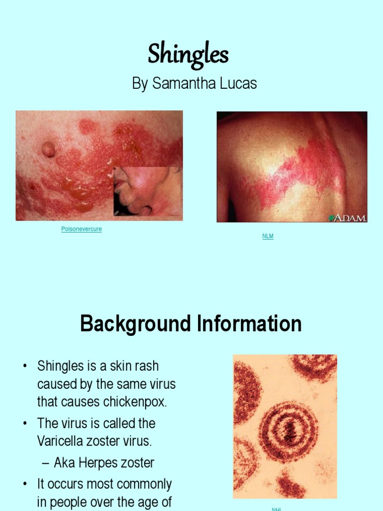 Shingles: By Samantha Lucas | Virology | Microbiology