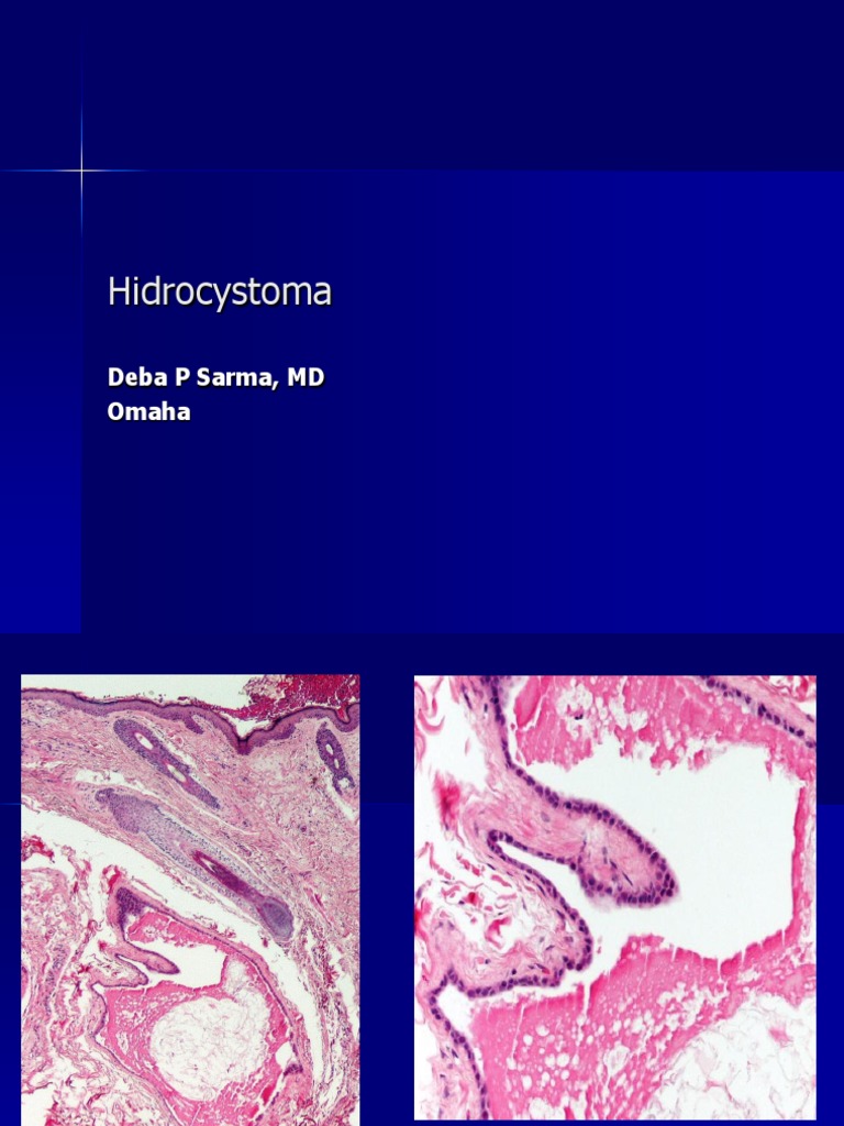 Hidrocystoma | PDF