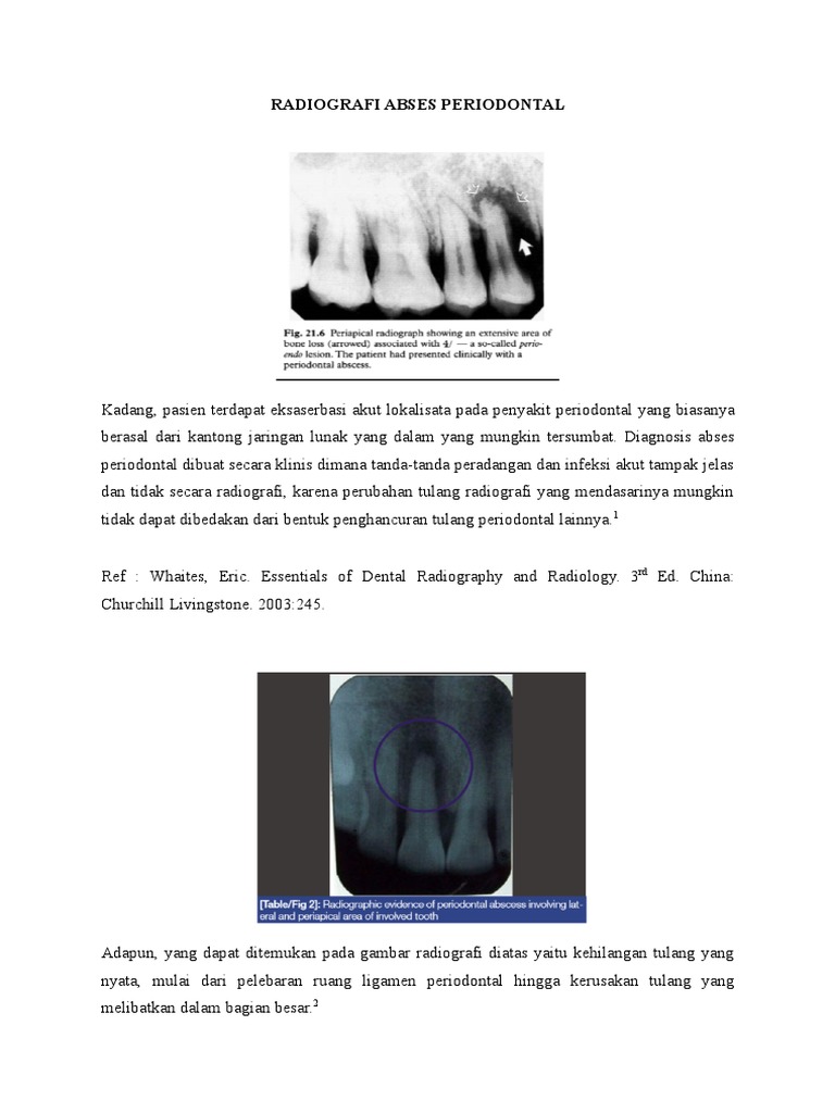 Radiografi Periodontal Abses | PDF