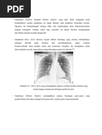 Bronkitis Akut Pdpi | PDF