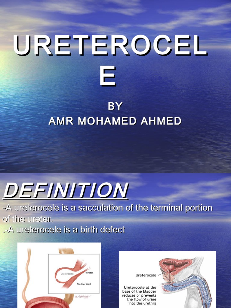 Ureterocele 130919225917 Phpapp02 | PDF | Urology | Medical Specialties