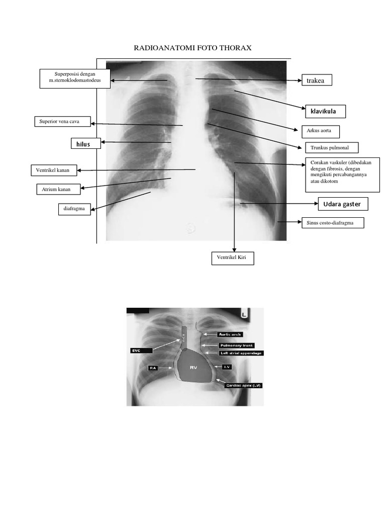 GAMBARAN NORMAL DAN ABNORMAL PADA RADIOGRAFI THORAX | PDF