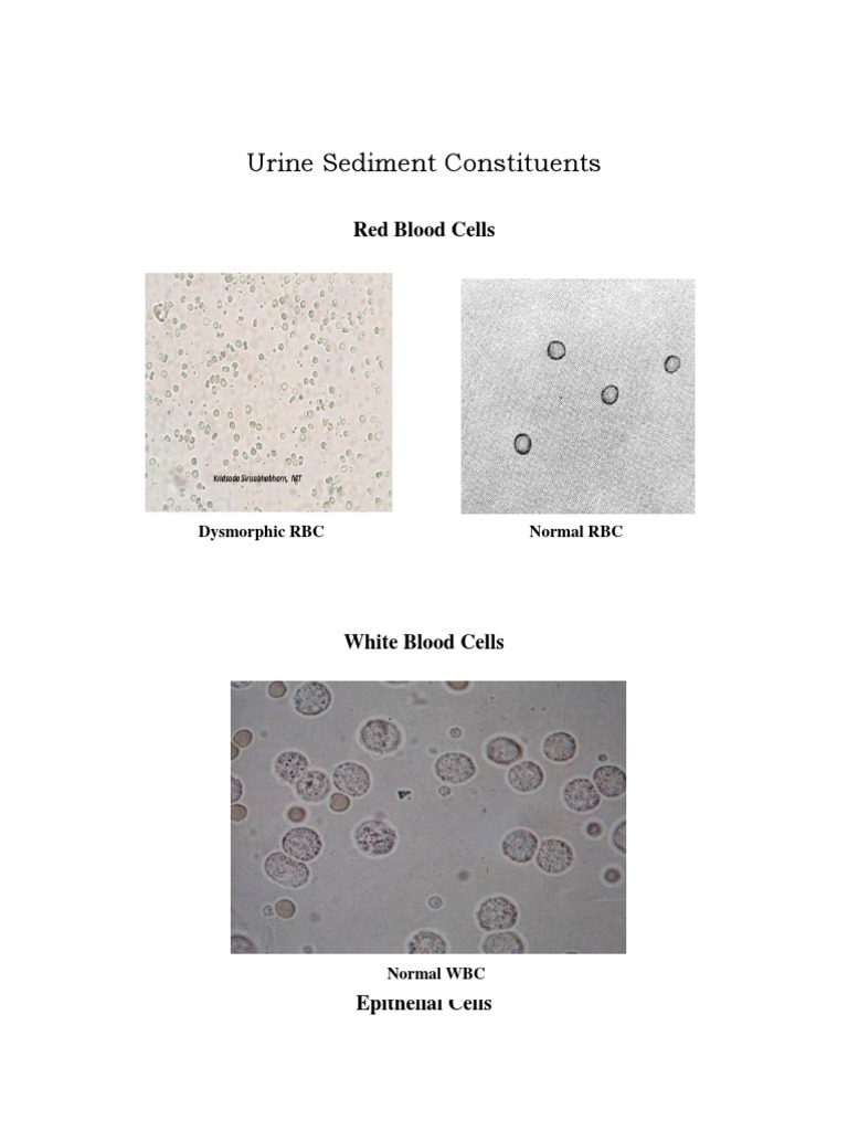 Urine Sediment Constituents: Red Blood Cells | PDF