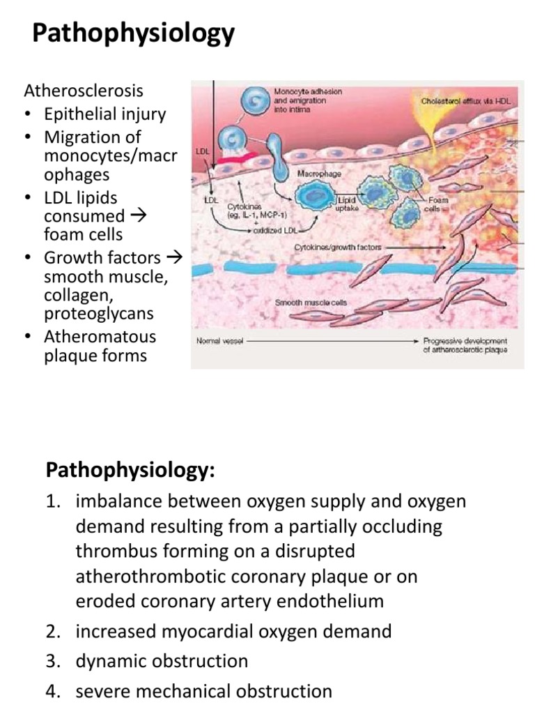 NSTEMI - Pathophysiology | PDF
