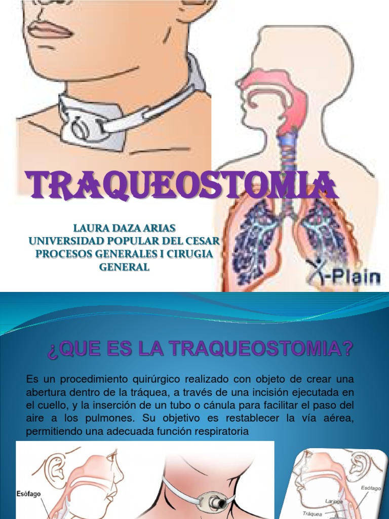 TRAQUEOSTOMIA | Enfermedades y trastornos | Sistema respiratorio