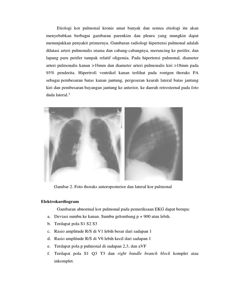Cor Pulmonal | PDF