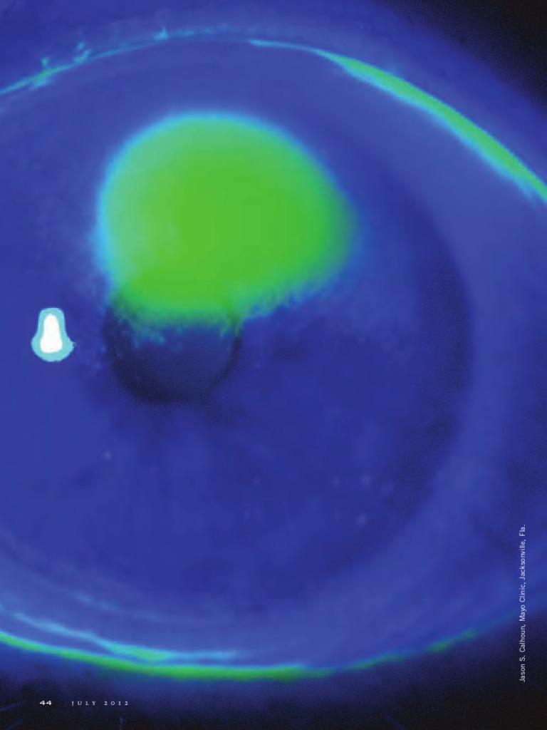 Corneal Ulcers | PDF | Contact Lens | Cornea