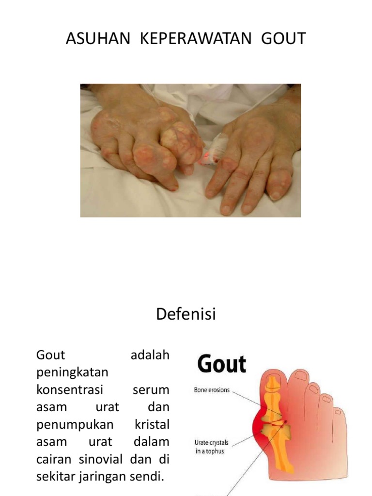 Gout | PDF | Sains & Matematika | Kesehatan Holistik