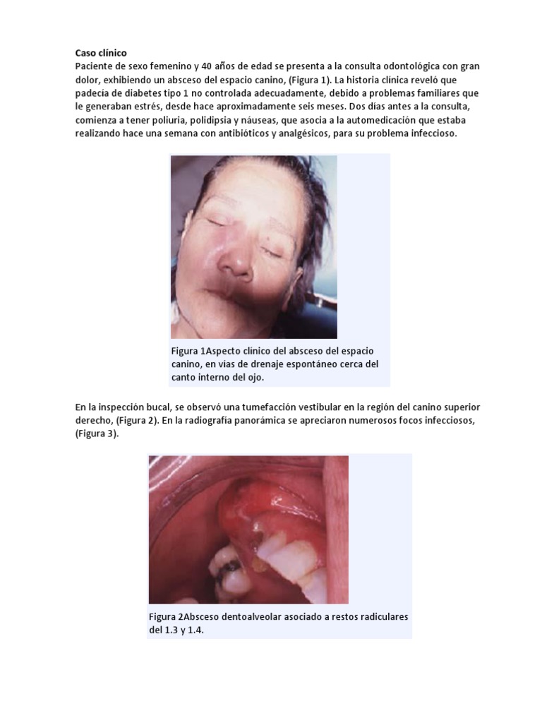 Caso Clínico de Absceso Periapical de Canino | PDF | Diabetes mellitus ...