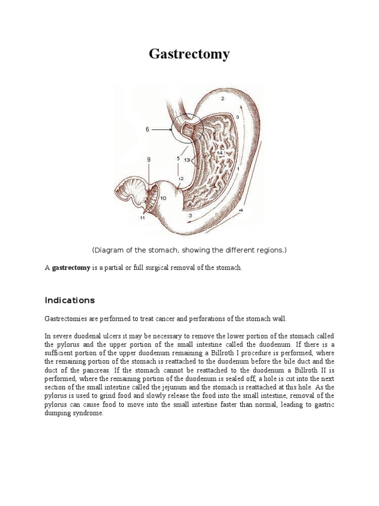 Gastrectomy | PDF | Gastroenterology | Organ (Anatomy)