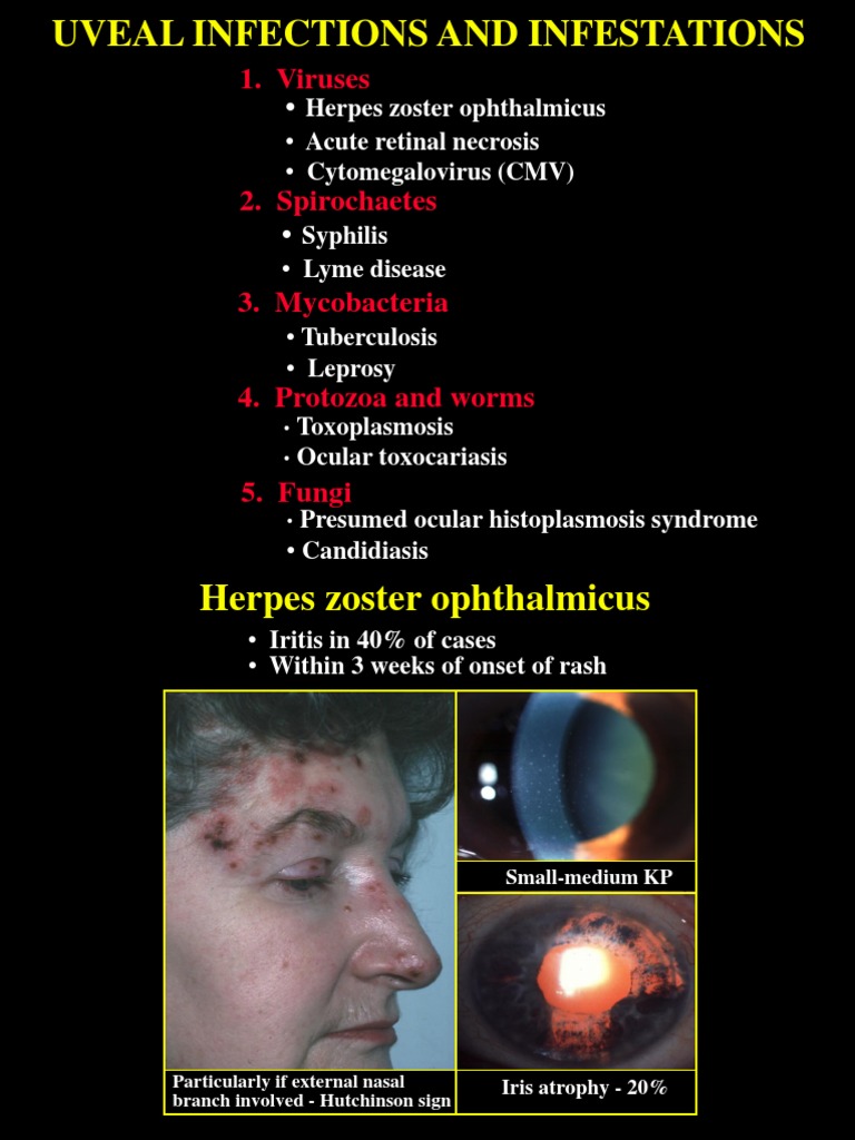 Uveal Infections & Treatments Guide | PDF | Hiv/Aids | Tuberculosis