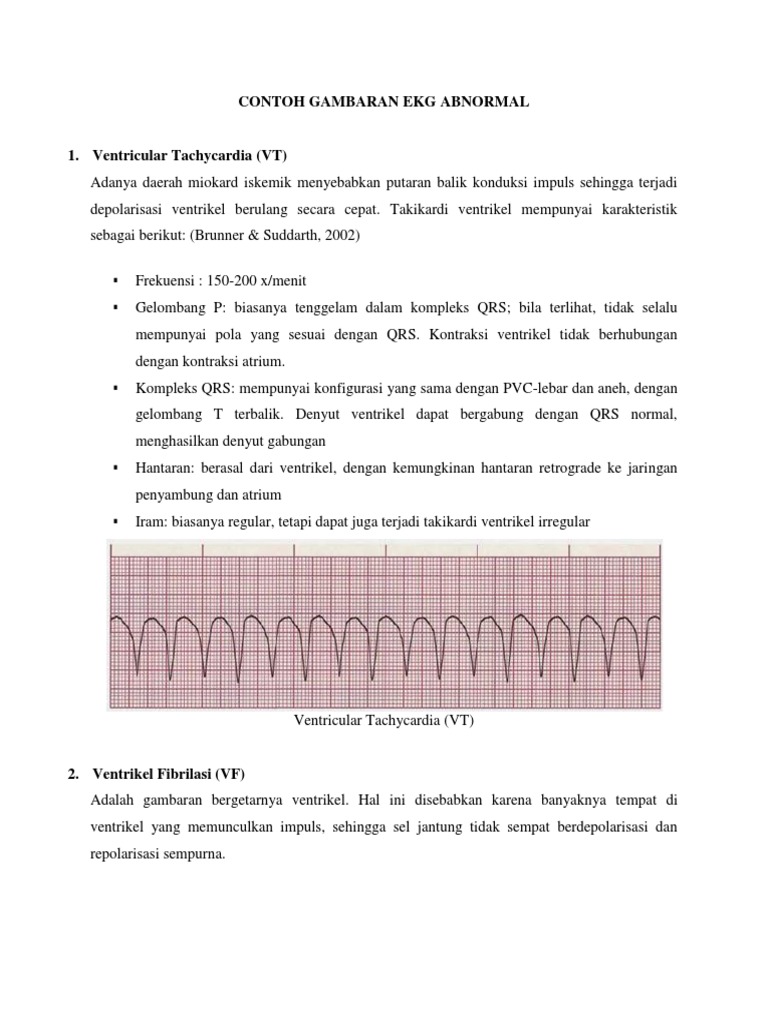 Contoh Gambaran Ekg Abnormal
