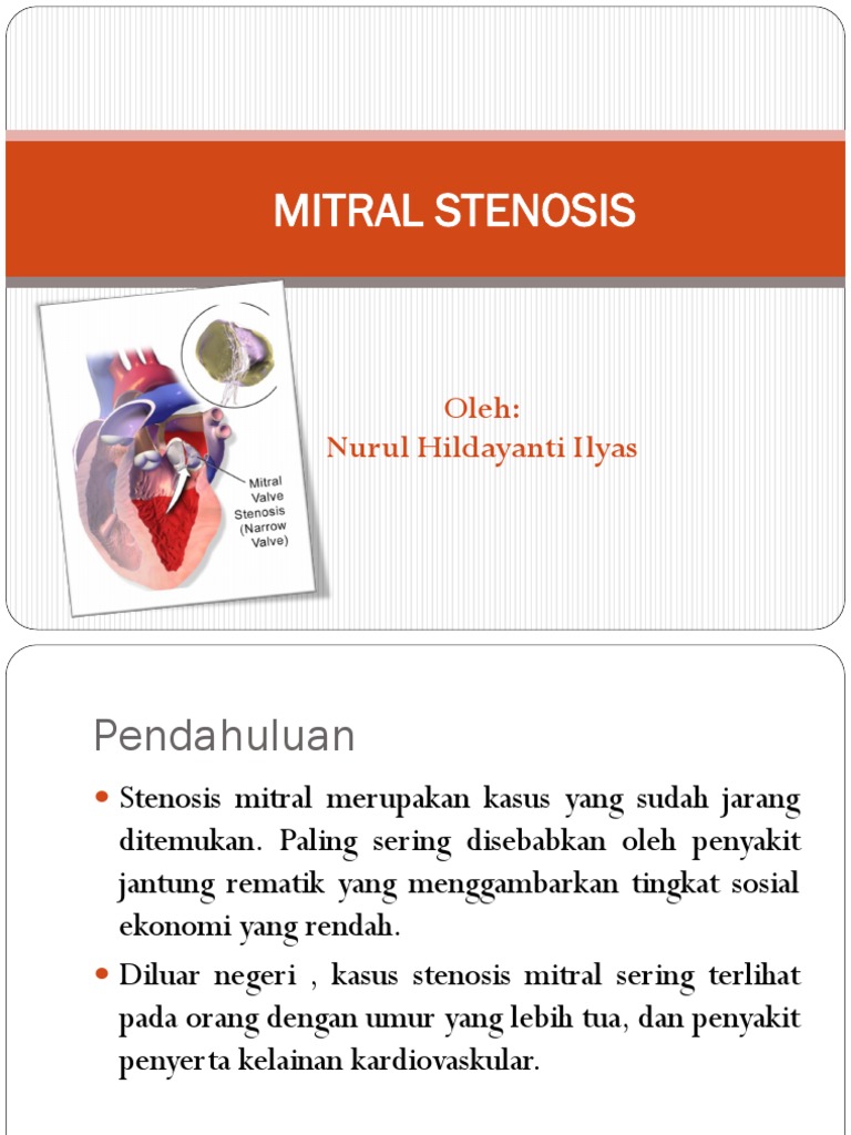 Mitral Stenosis | PDF | Sains & Matematika