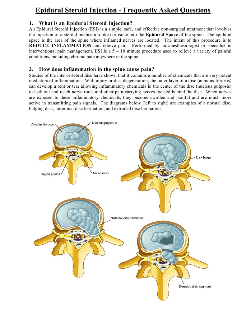 Epidural Steroid Injection | PDF | Pain | Clinical Medicine