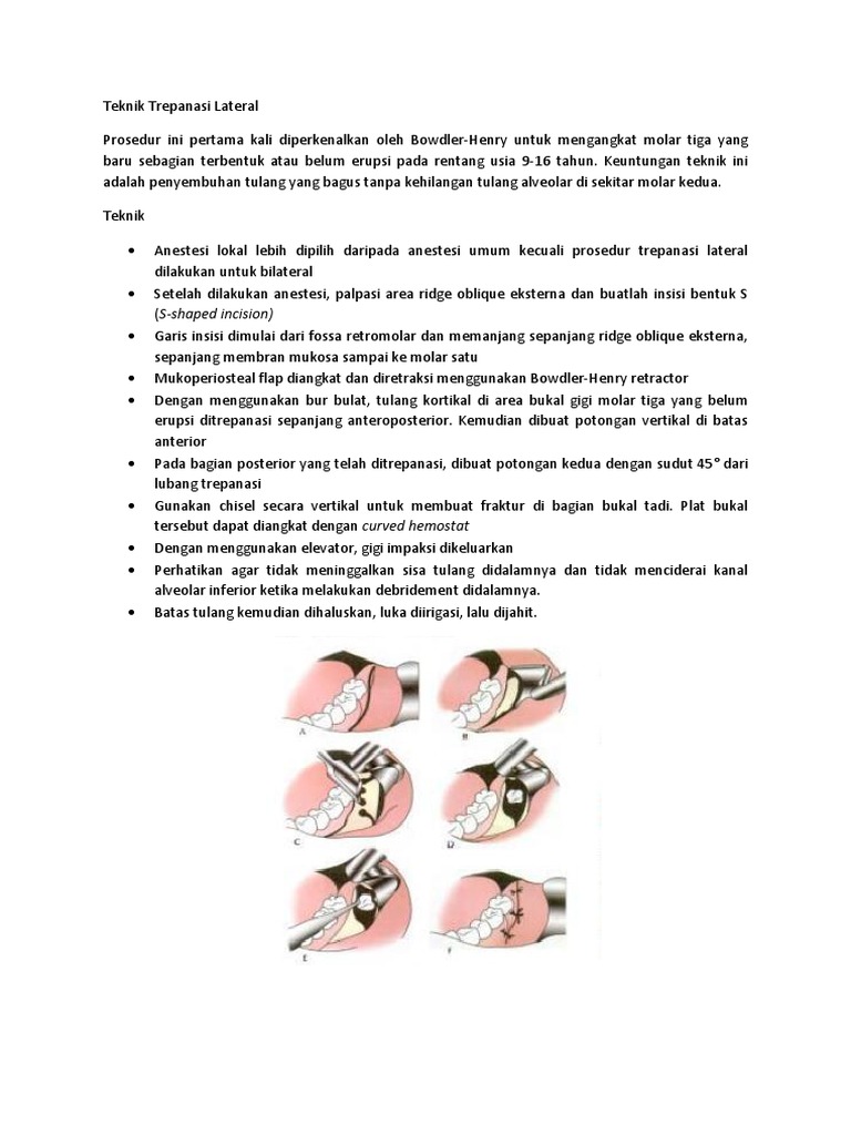 Teknik Trepanasi Lateral | PDF