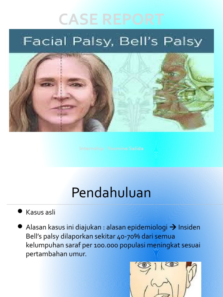 Bells Palsy | PDF