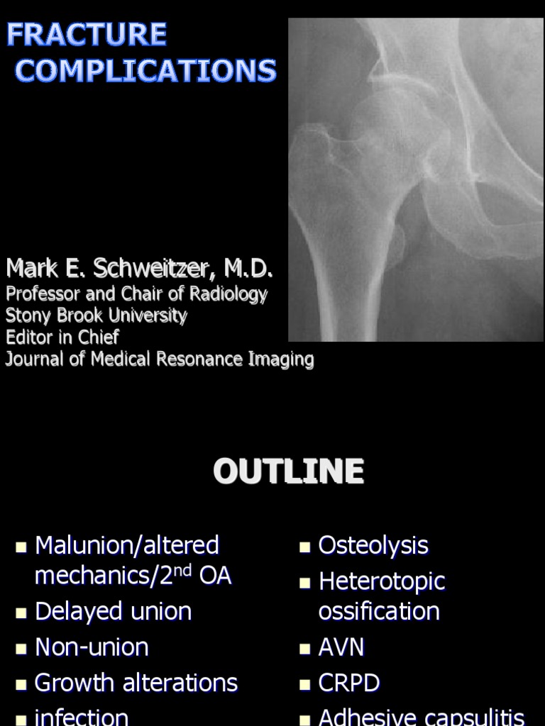 Bone Fracture Complications Guide | PDF | Ankle | Knee