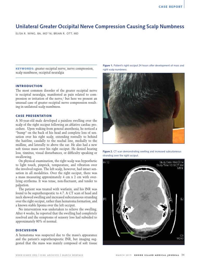 Unilateral Greater Occipital Nerve Compression Causing Scalp Numbness ...