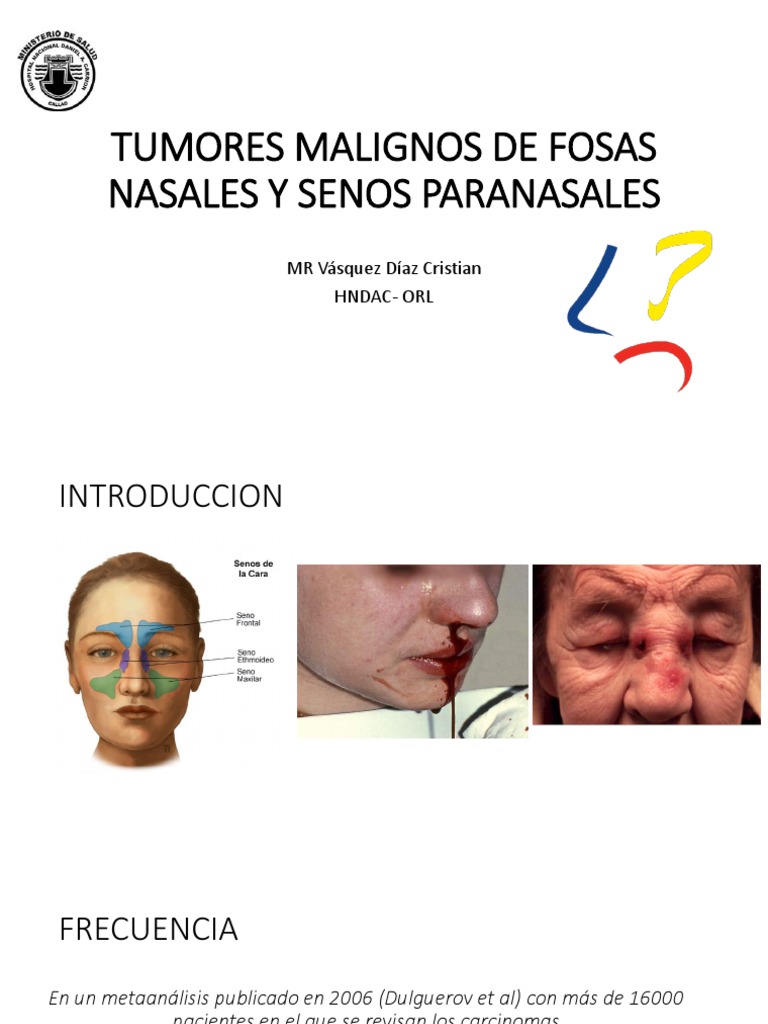 Tumores Malignos de Las Fosas Nasales y Senos (Autoguardado) | PDF | Sarcoma | Cáncer