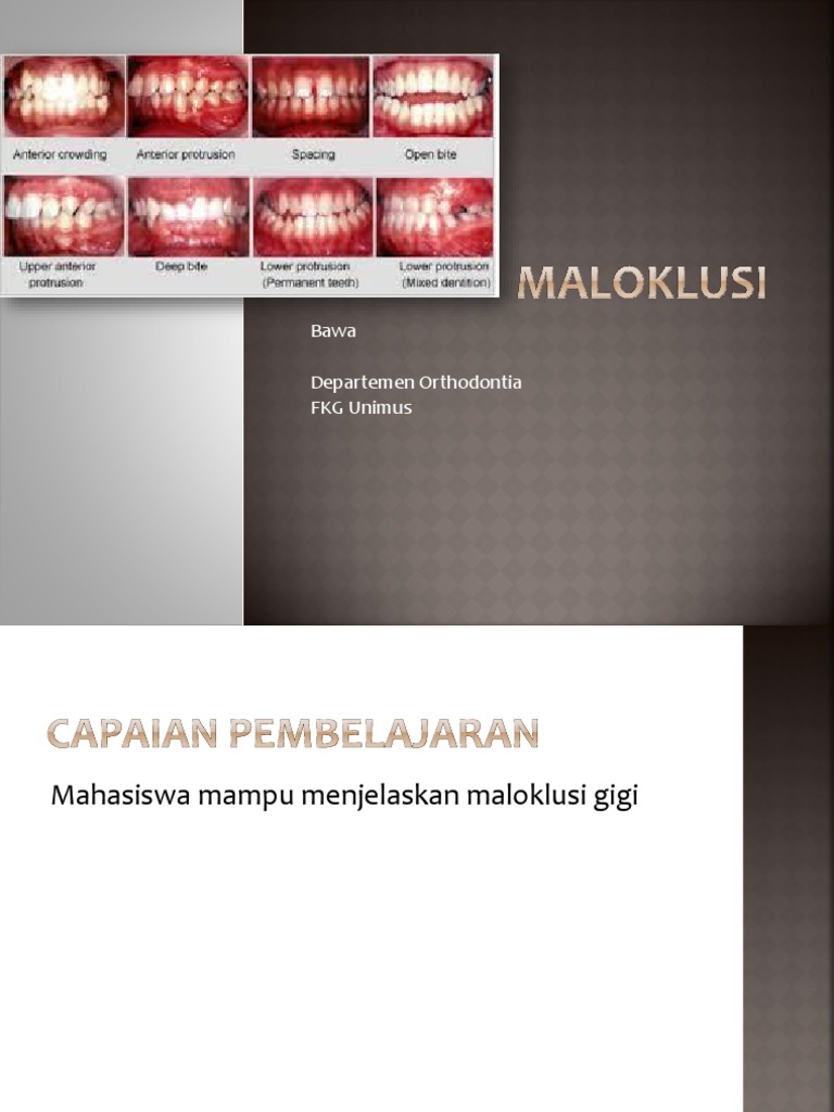 Maloklusi Gigi: Penyebab dan Klasifikasi | PDF | Sains & Matematika