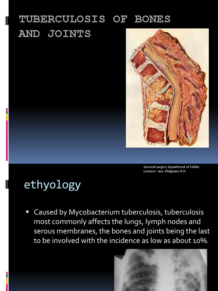 Bone and Joint Tuberculosis Overview | PDF | Tuberculosis | Bone
