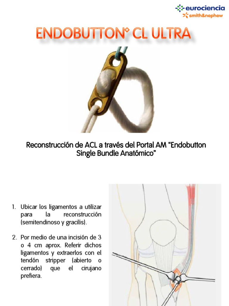 Endobutton CL Ultra TECNICA v2 | PDF | Extremidades (anatomía ...