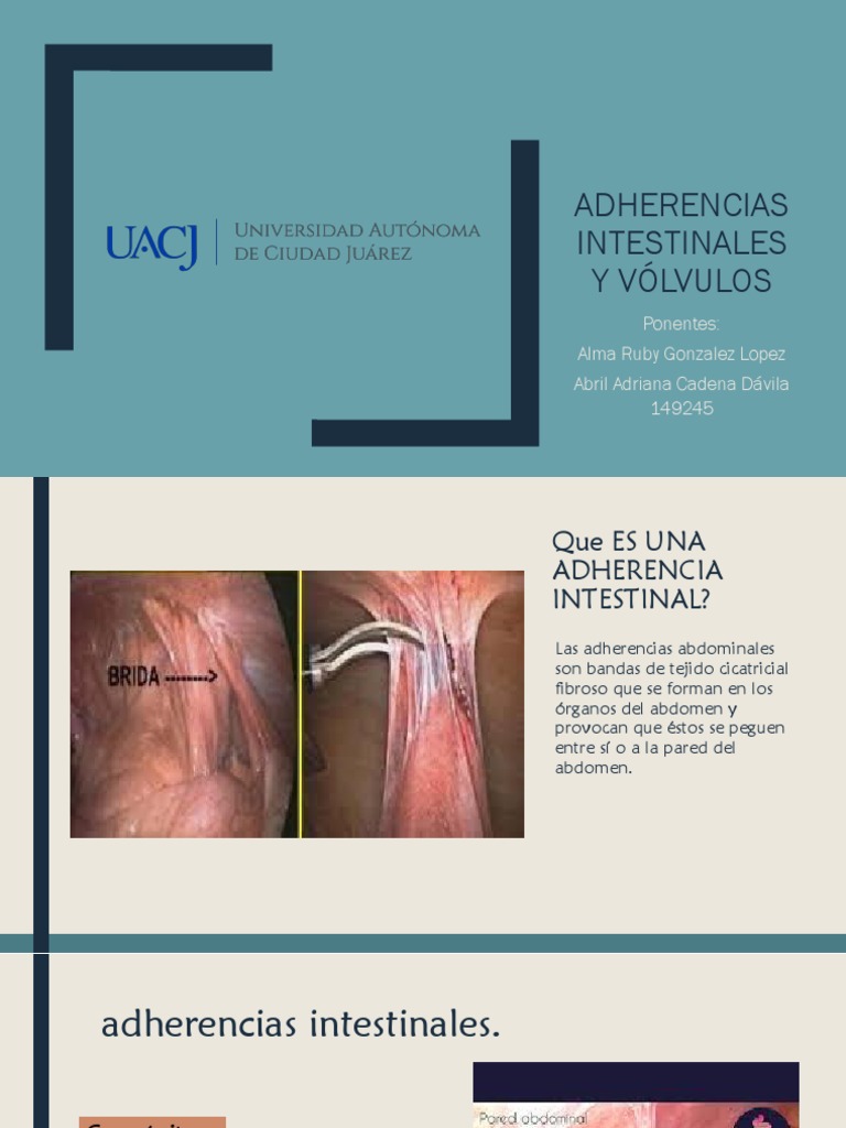 Adherencias Intestinales y Volvulos | PDF | Inflamación | Ciencias de ...