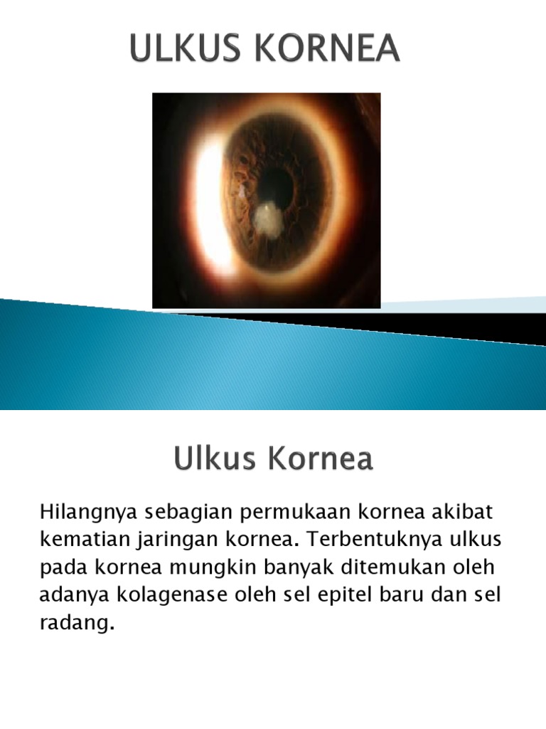 Ulkus Kornea | PDF