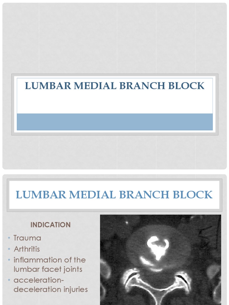Lumbar Medial Branch Block Guide | PDF | Vertebra | Vertebral Column