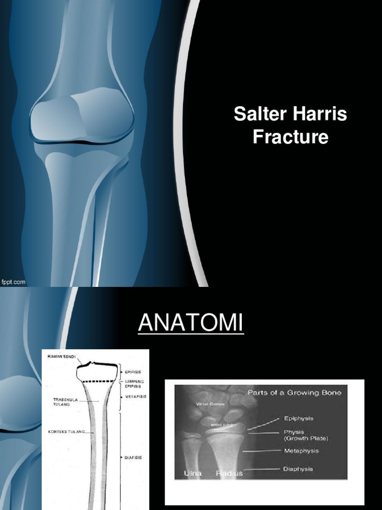 Salter Harris Fracture | PDF