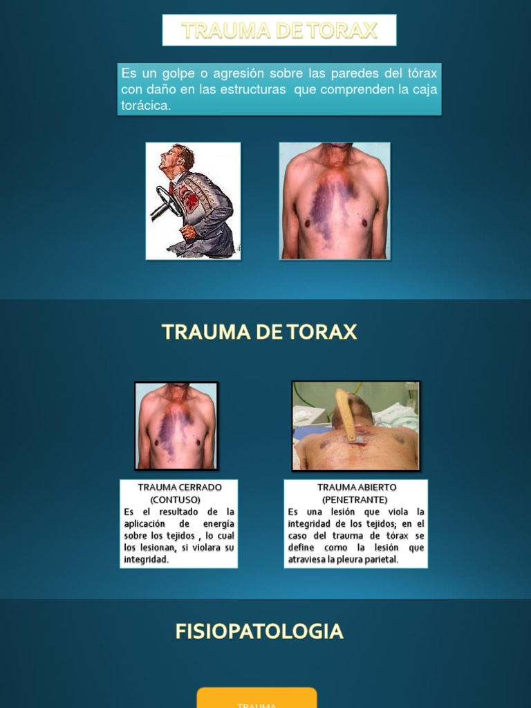 Trauma Torax | PDF