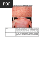 Tatalaksana Morbili dan Diagnosanya | PDF | Kesehatan Holistik | Sains ...