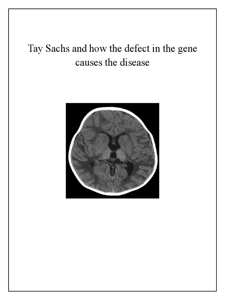 GeneticDisease Tay Sachs | PDF | Medical Genetics | Human Diseases And ...