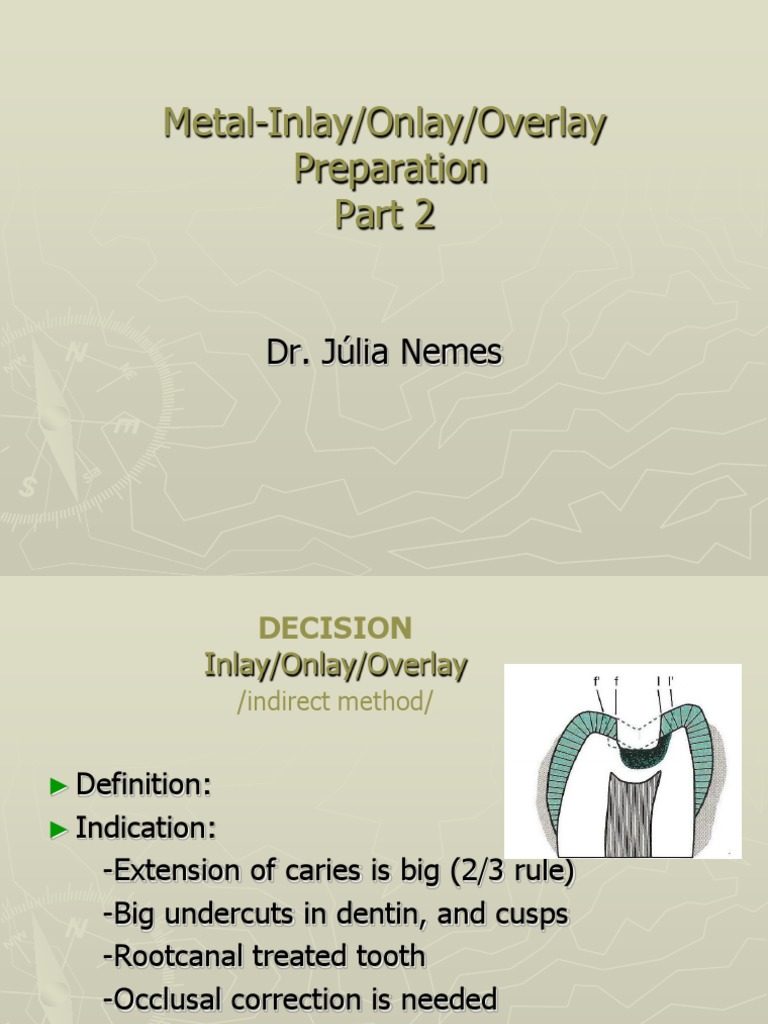 Metal-Inlay/Onlay/Overlay Preparation: Dr. Júlia Nemes | PDF | Tooth ...