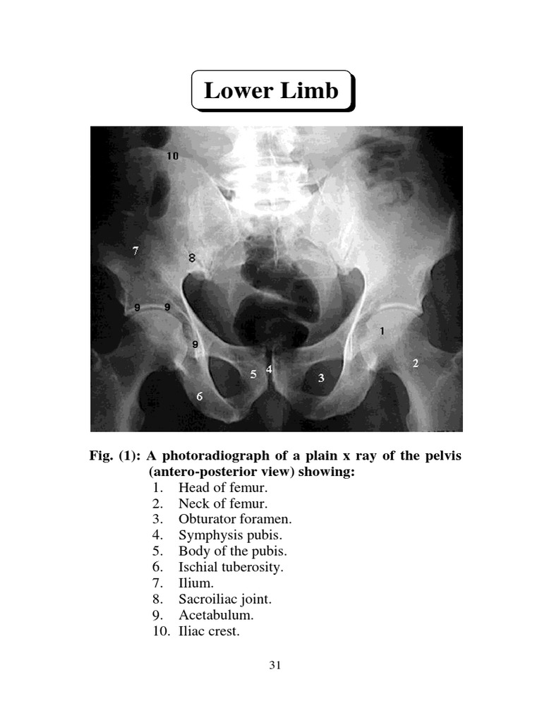 Lower Limb: Fig. (1) : A Photoradiograph of A Plain X Ray of The Pelvis ...