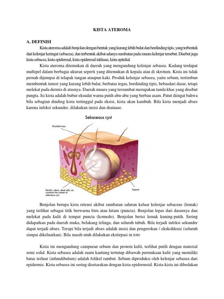 Kista Ateroma: Penyebab dan Terapi | PDF