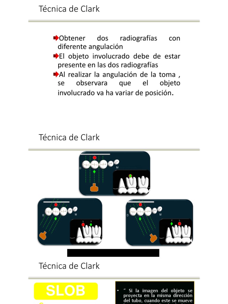 Técnica de Clark en Radiografía Dental | PDF