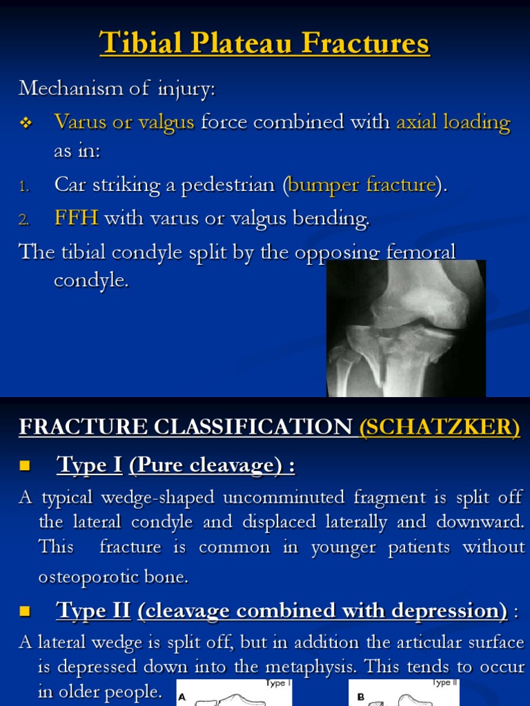 Tibial Plateau Fractures: Varus or Valgus Axial Loading Bumper Fracture ...