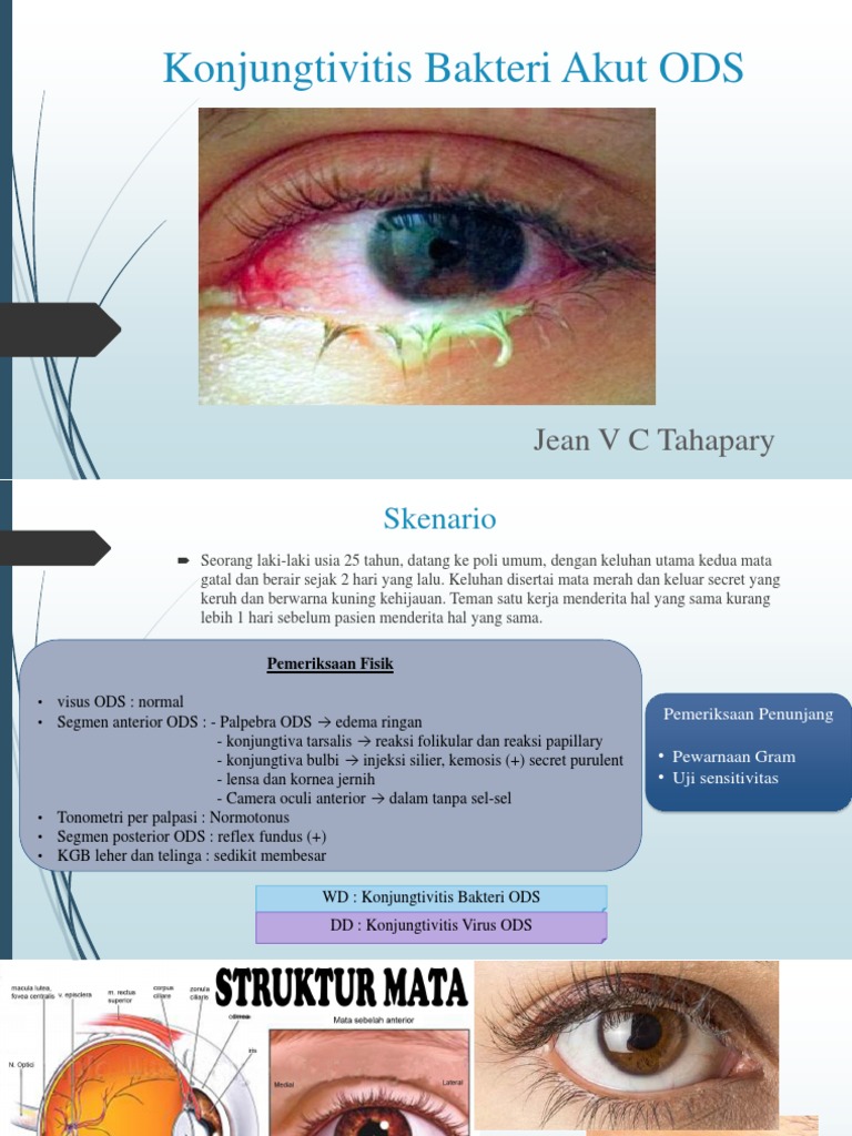 Konjungtivitis Bakteri ODS | PDF