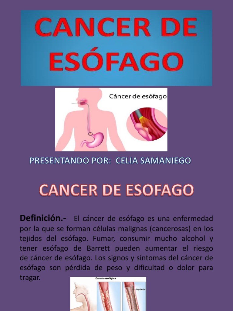 Diapositivas Cancer de Esofago | PDF | Cáncer de esófago | Cáncer