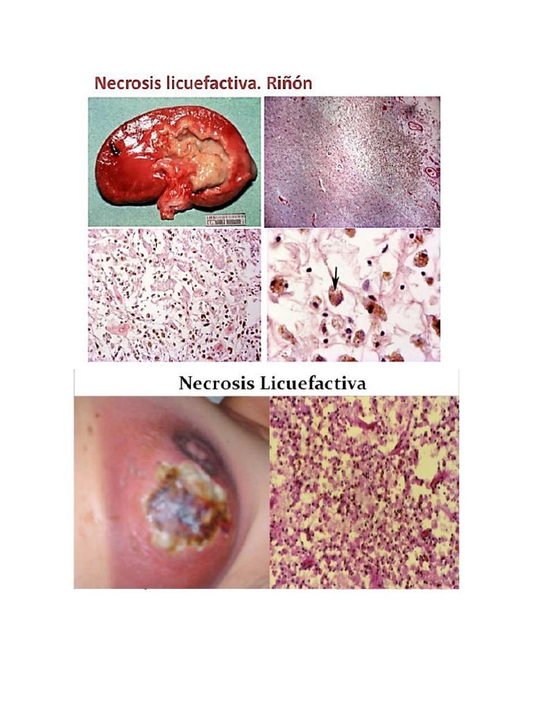 Necrosis Licuefactiva | PDF