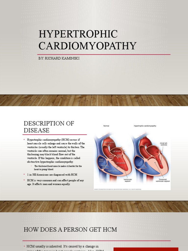 Hypertrophic Cardiomyopathy Powerpoint | PDF | Heart | Cardiovascular ...