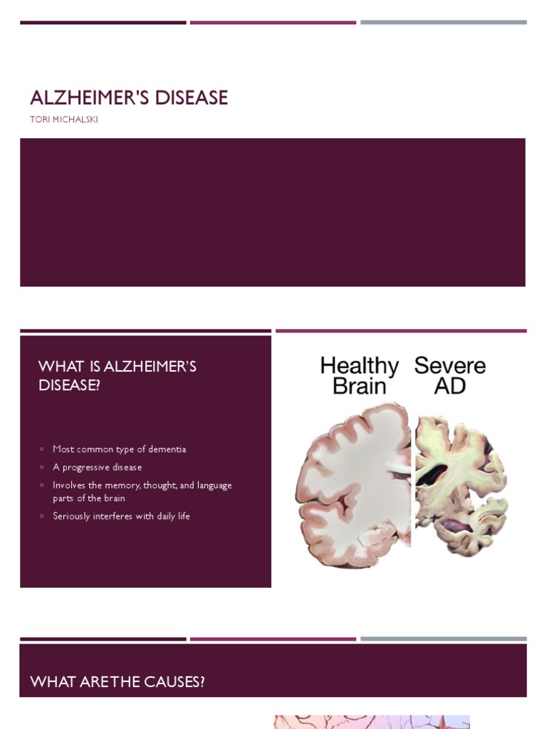 Alzheimers Disease Presentation | PDF | Alzheimer's Disease | Dementia