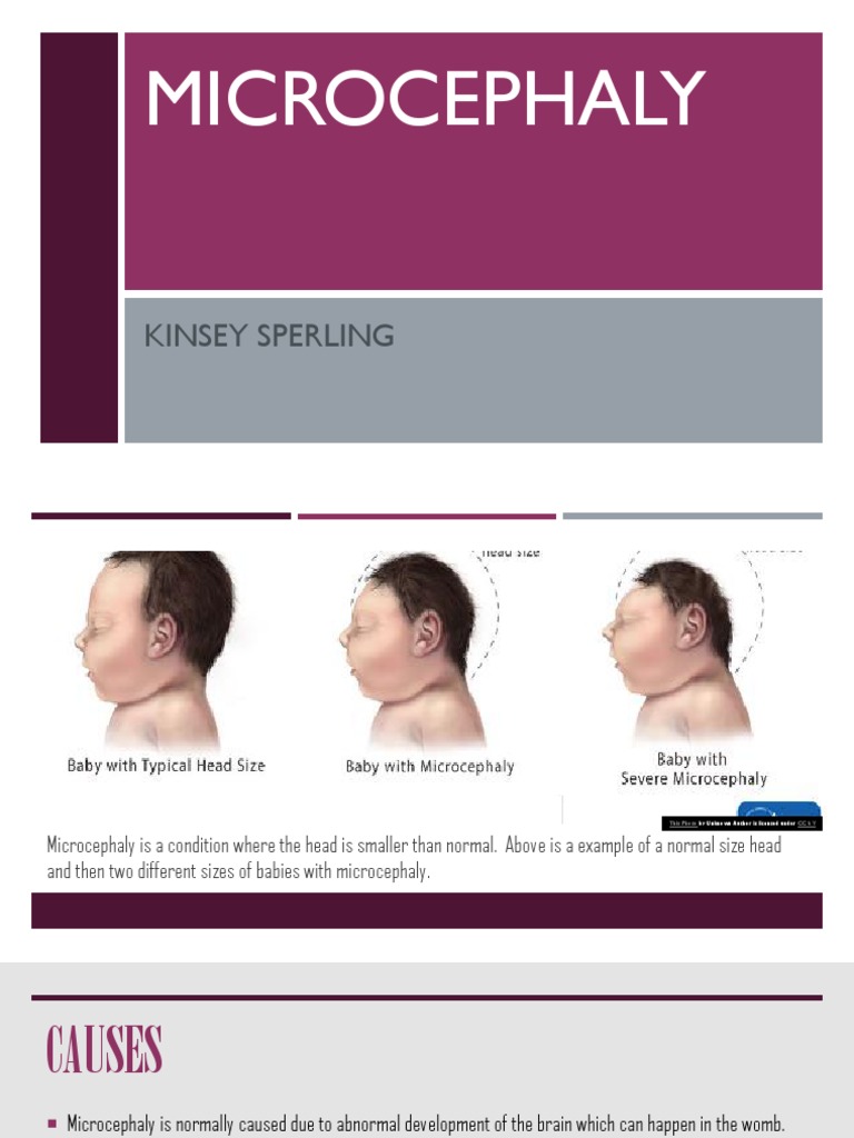 Microcephaly | PDF | Prenatal Development | Medicine