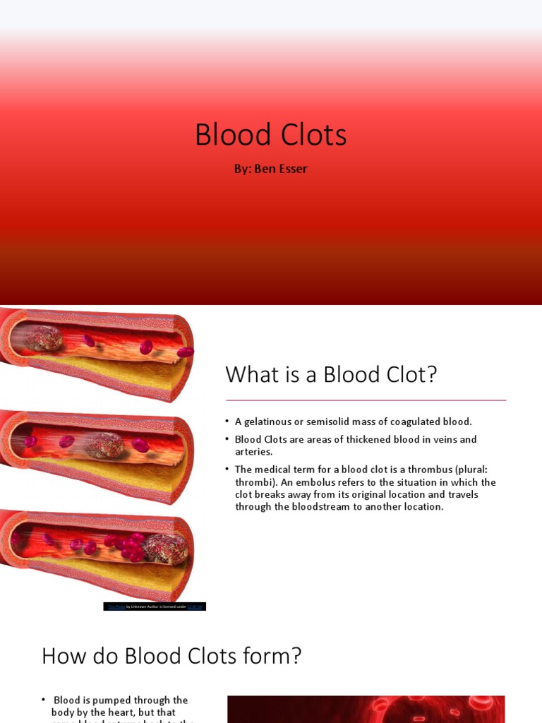 Blood Clots | PDF | Embolism | Thrombus