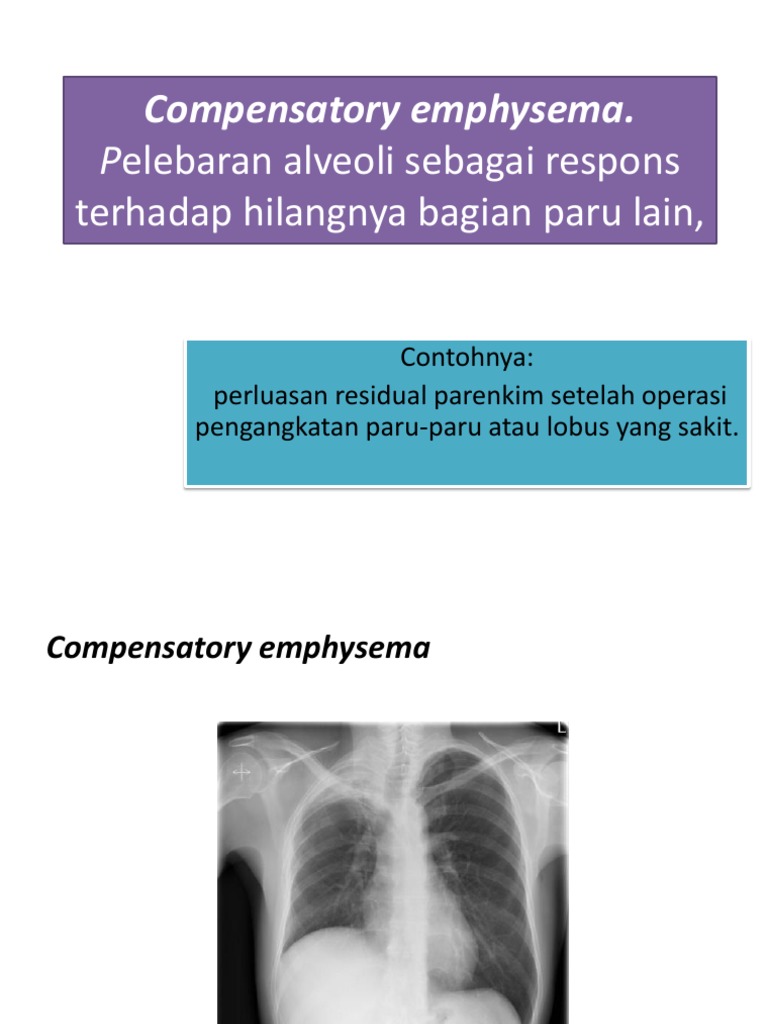 Compensatory Dan Bullae Emphysema | PDF