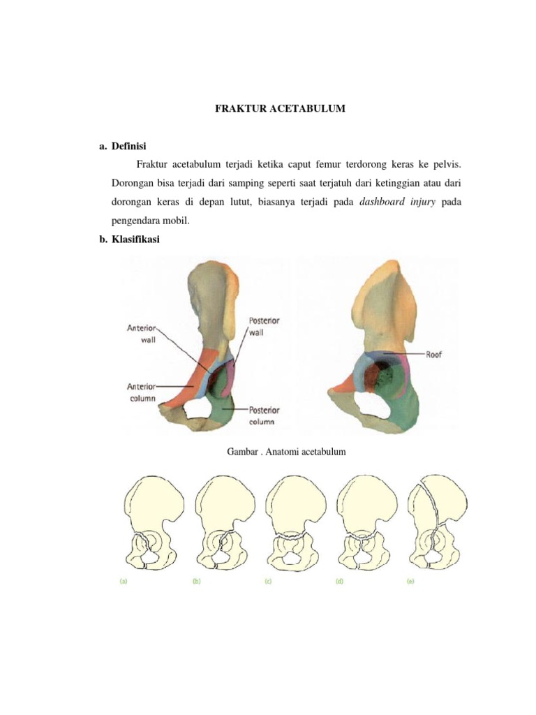 Klasifikasi dan Penanganan Fraktur Acetabulum | PDF | Sains & Matematika