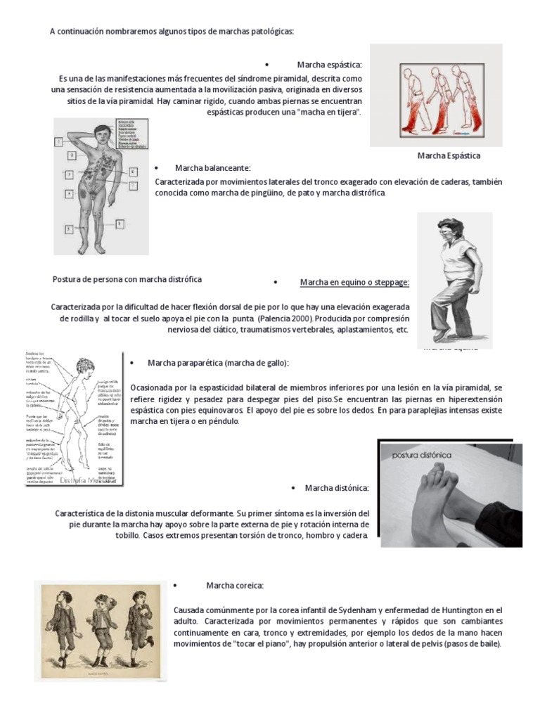 Tipo de Marcha | Distonia | Pie