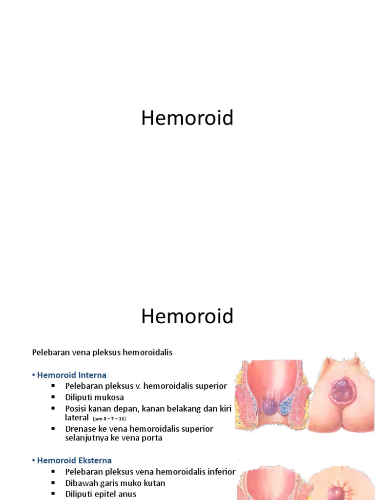 Hemoroid | PDF